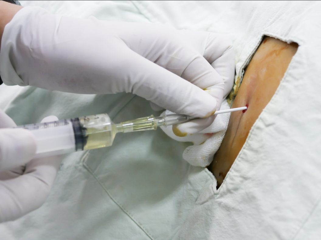 Paracentesis