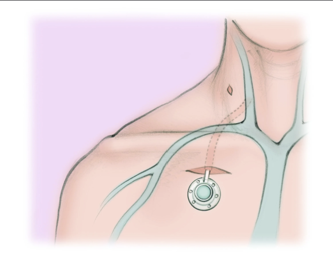 Port-a-Cath (Puerto Venoso Implantable)